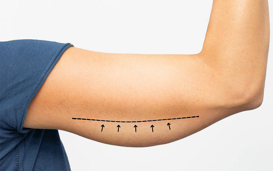 Expectations of a patient after undergoing an Arm lift Surgical ...